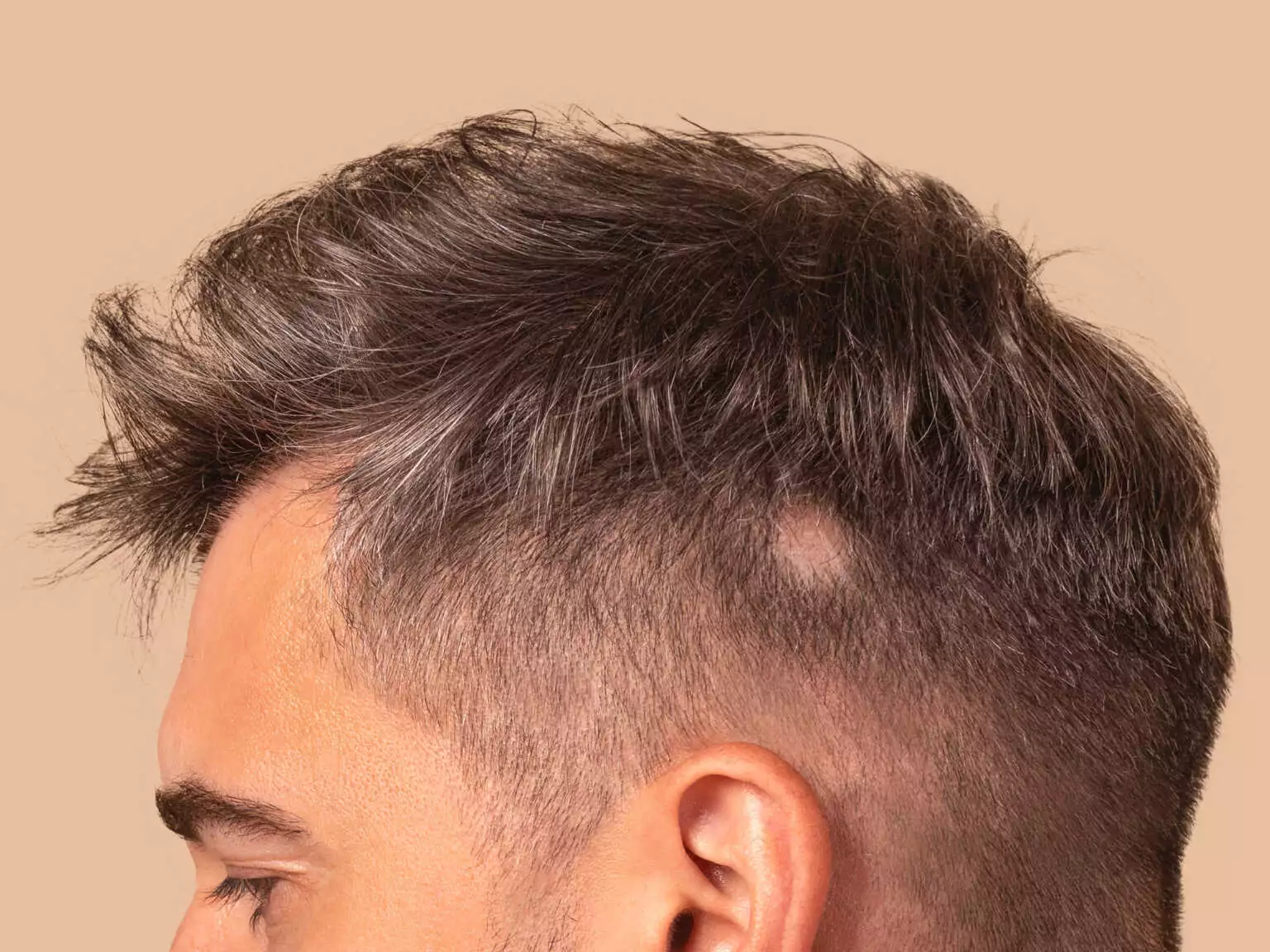 Γυροειδής Αλωπεκία: Τι είναι και πώς επηρεάζει την ποιότητα ζωής των πασχόντων; - IRI Beyond