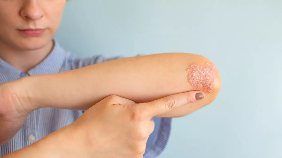 Ψωρίαση: Η δερματοπάθεια που δεν κάνει διακρίσεις – Ο ρόλος του στρες - IRI Beyond